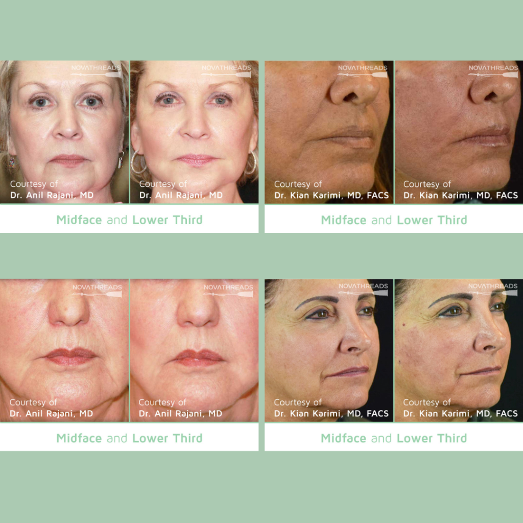 Tread Lift - ICS By Fustok